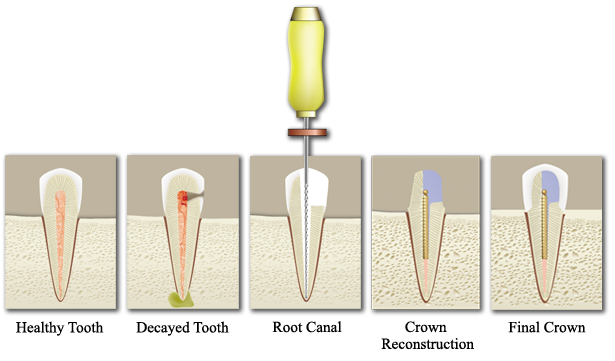Partial Root Canal